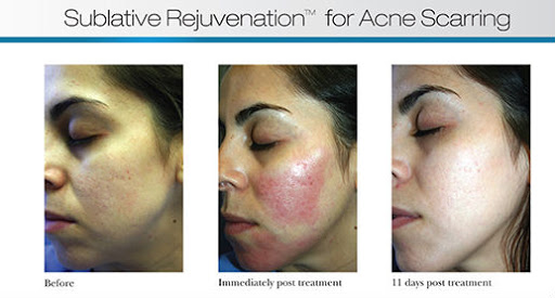 Sublative Matrix RF til grova húð/arr - Klinikk B