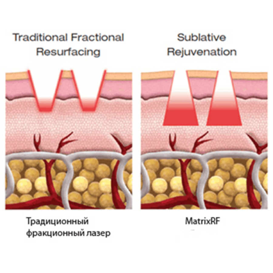 Sublative Matrix RF til grova húð/arr - Klinikk B