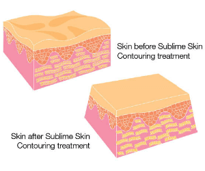 Sublime ST - Húðuppstramman - Klinikk B