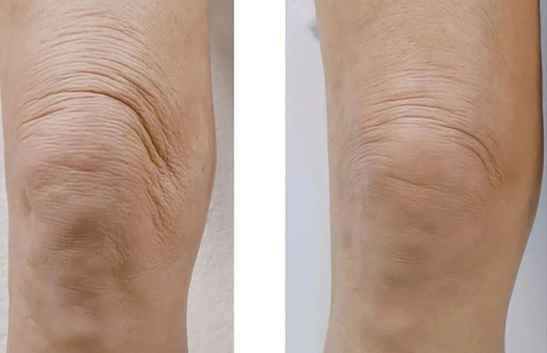 PROFHILO BODY - Klinikk B